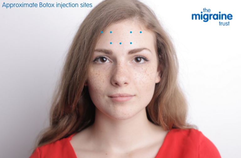 Botox for migraine: What to expect - The Migraine Trust