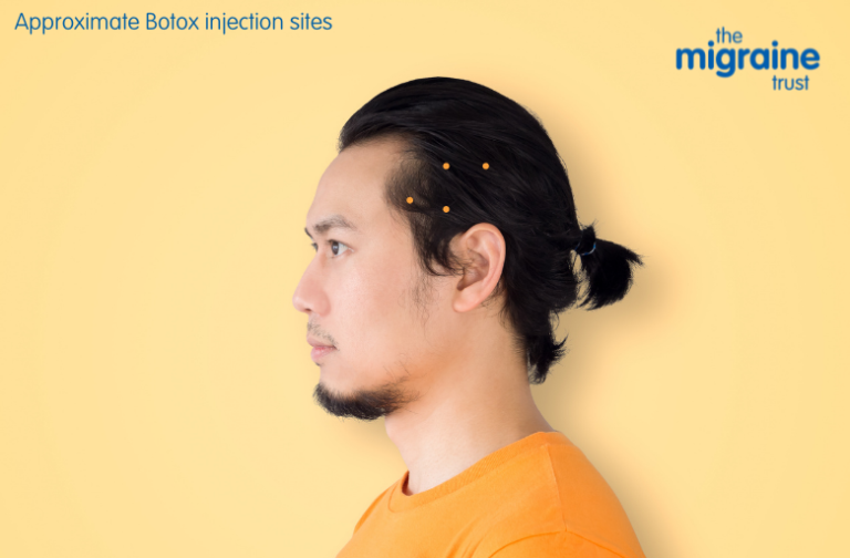 Botox for migraine: What to expect - The Migraine Trust