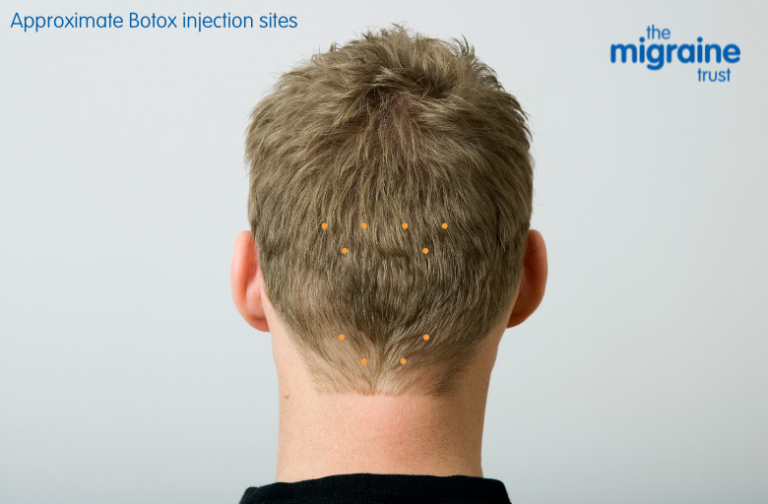 Botox for migraine: What to expect - The Migraine Trust